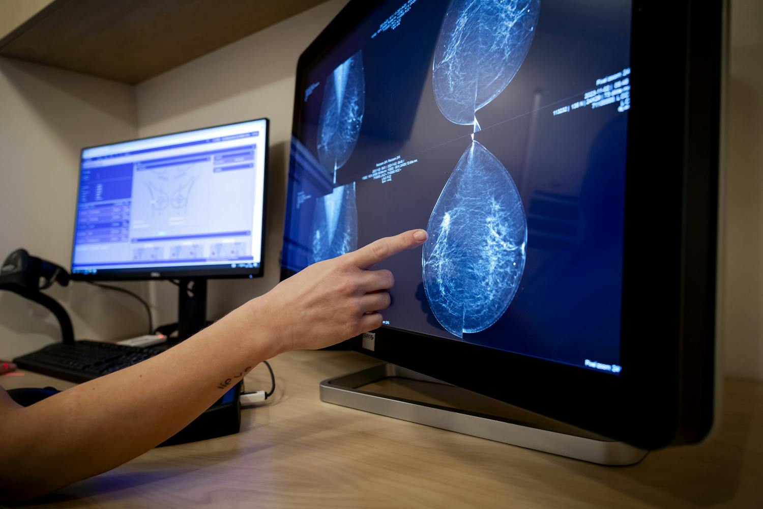 Nederlands ziekenhuis zet als één van eersten AI in bij het opsporen van borstkanker | BNR ...
